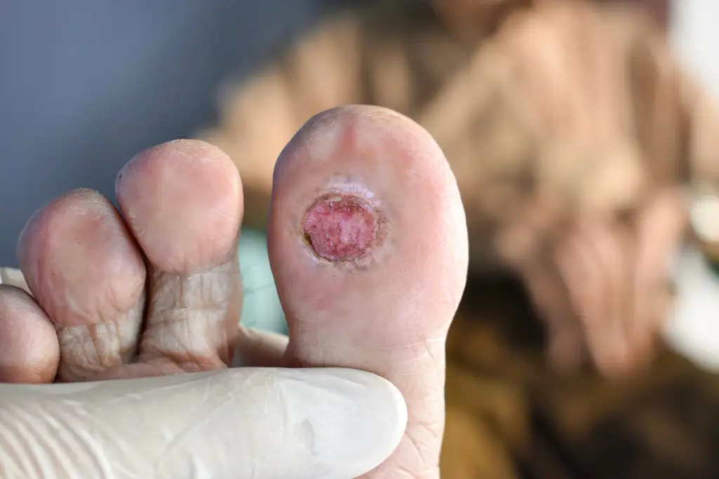 Feridas de diabetes: Conheça os 3 tipos principais